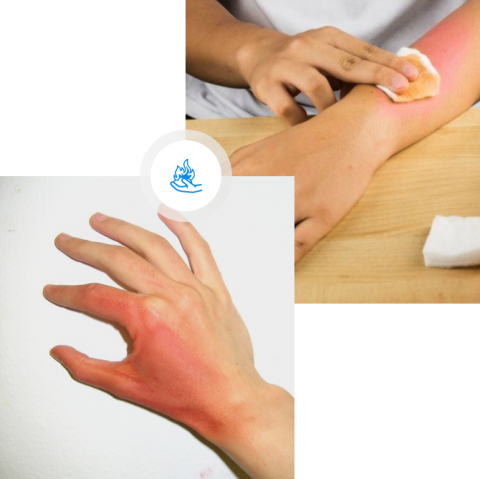 Minor burns | Foundation Health